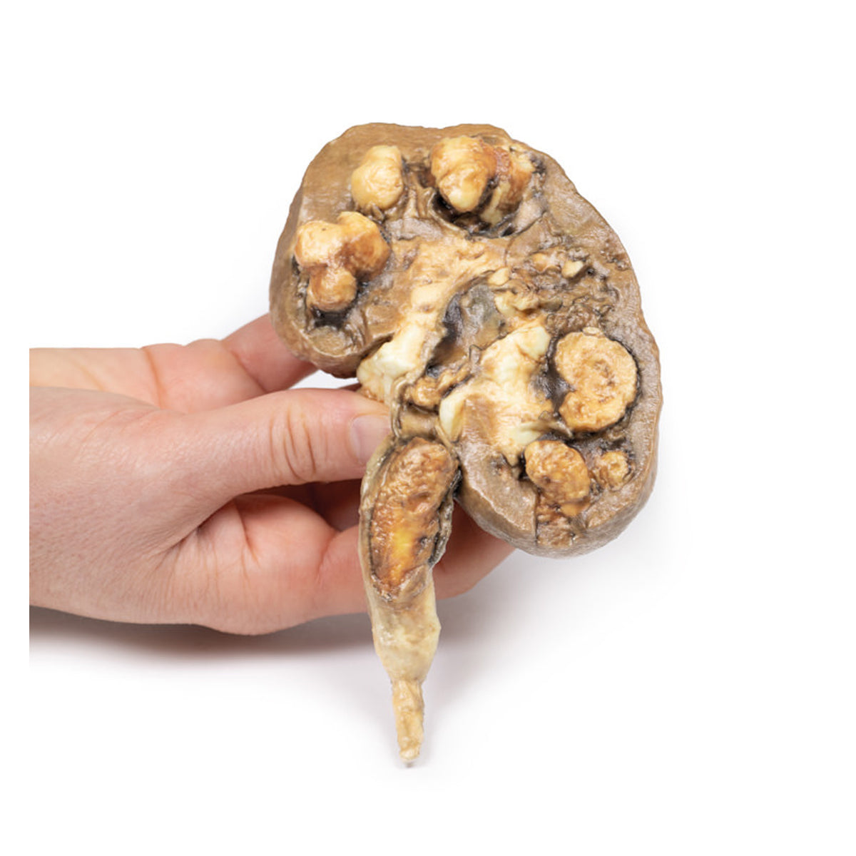 Multiple Renal Calculi – Sim & Skills