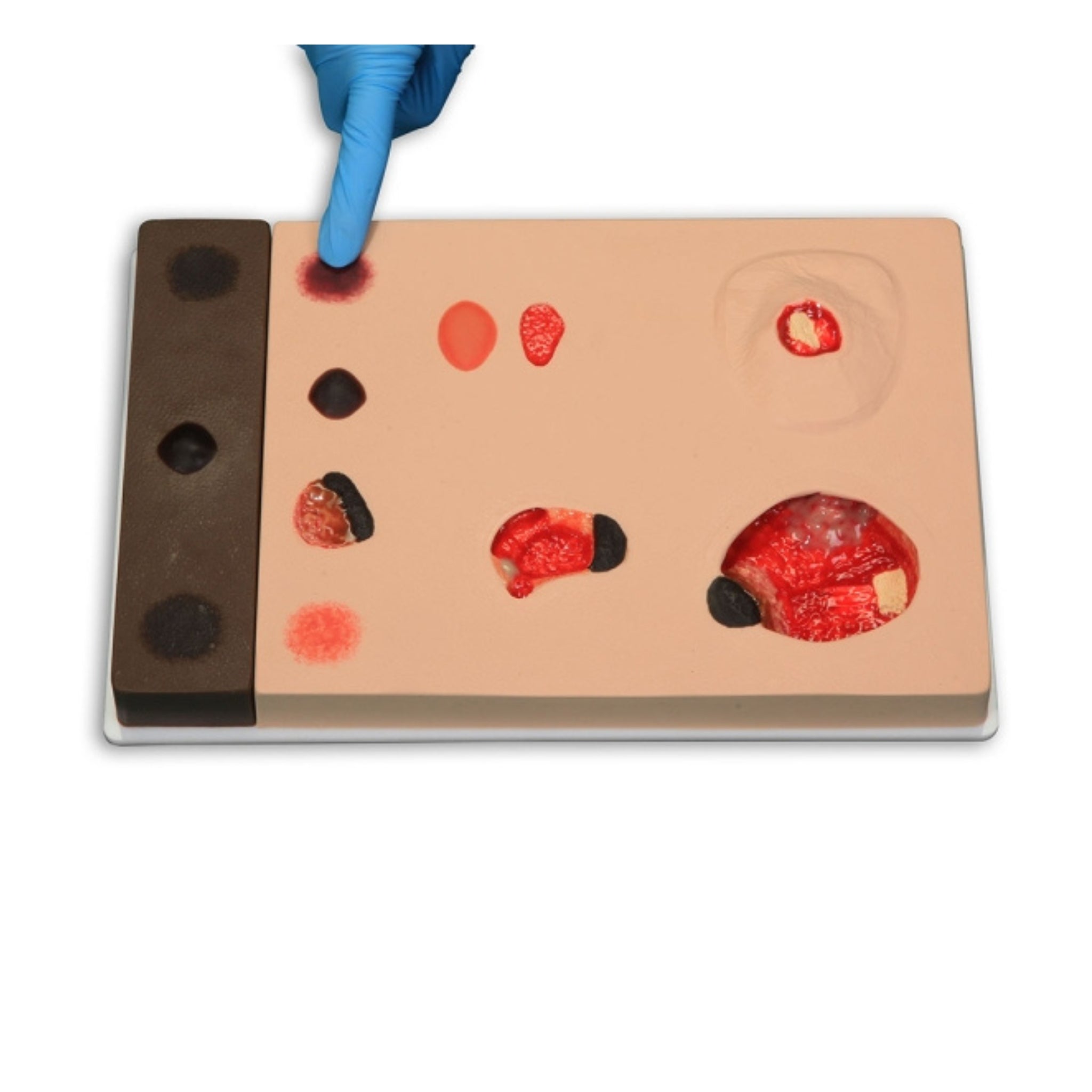 Pressure Sores & Ulcer Models - Realistic Wound Care Training — Sim ...